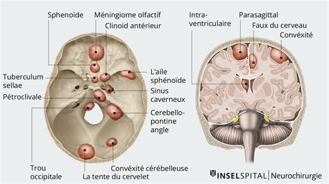 Méningeome Neurochirurgie Inselspital Bern