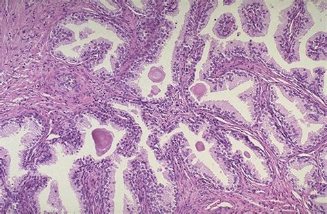 Pathology Outlines Benign Prostatic Hyperplasia