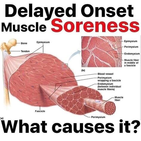 Delayed Onset Muscle Soreness