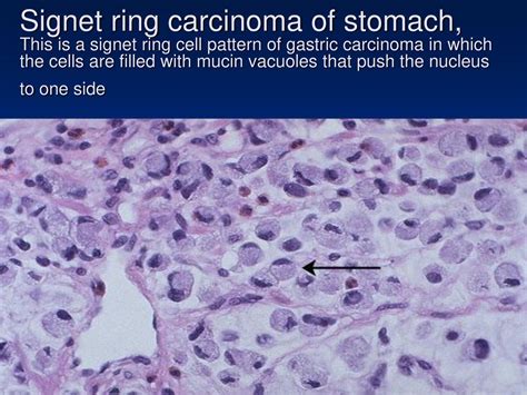 Pleomorphic Adenoma The Tumour At The Left Side Is White Gray Firm