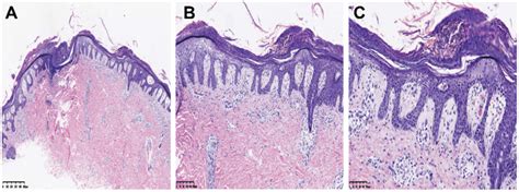 Pathological Images Pathological Results Showed Hyperkeratosis