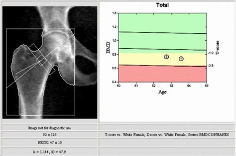 Understanding Your Bone Density Scan Results