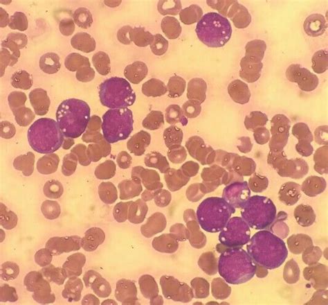 Burkitt Lymphoma Hematology Burkitts Lymphoma Medical Laboratory