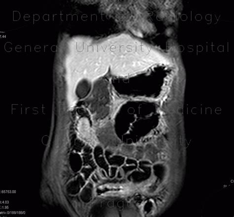 Radiology Case Crohns Disease Mr Enterography