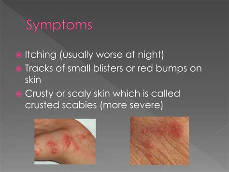 Ppt Scabies Powerpoint Presentation Free Download Id 392899