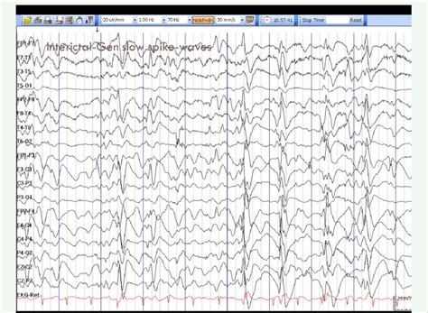 Eeg Revealing Interictal Bursts Of Generalized Slow Spike And Wave