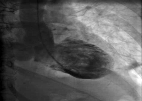 One Heart Two Cardiomyopathies Bmj Case Reports