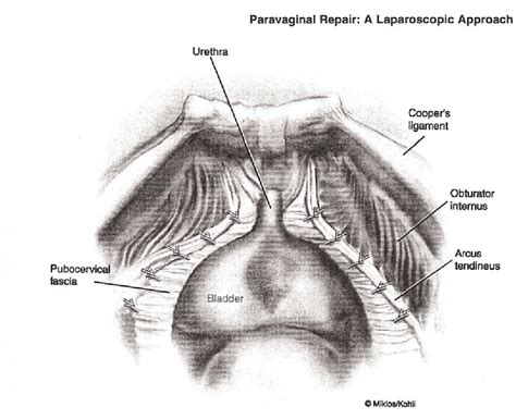 [pdf] 44 Paravaginal Repair A Laparoscopic Approach Semantic Scholar