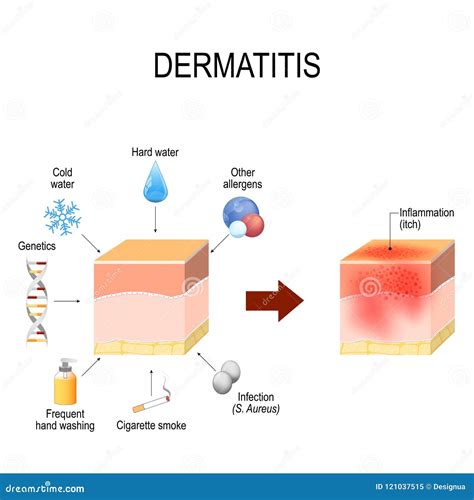 Atopic Dermatitis Causes