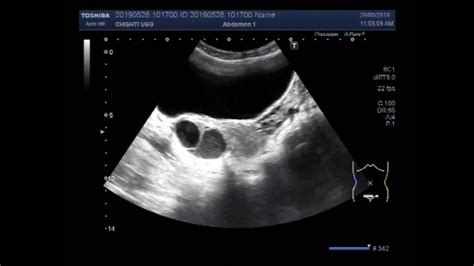 Ultrasound Video Showing Difference Between The Simple And Hemorrhagic
