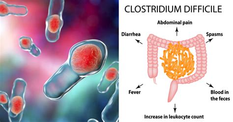 C Diff Causes Symptoms And 6 Home Remedies David Avocado Wolfe