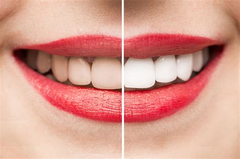 Why In Office Teeth Bleaching Is Worth The Expense Tompkins Oral