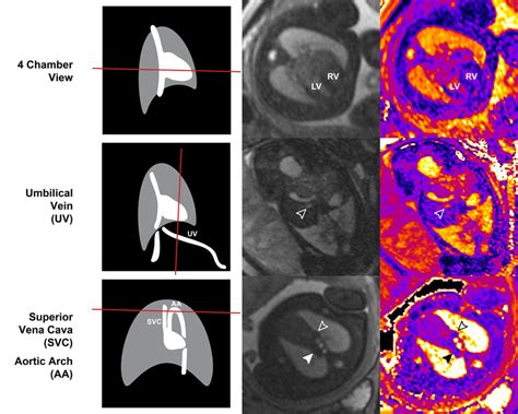 Fetal Magnetic Resonance Oximetry By T2 Mapping Download Scientific