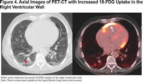 Copd Images Emphysema And Fibrosis With Hypertension Journal Of Copd