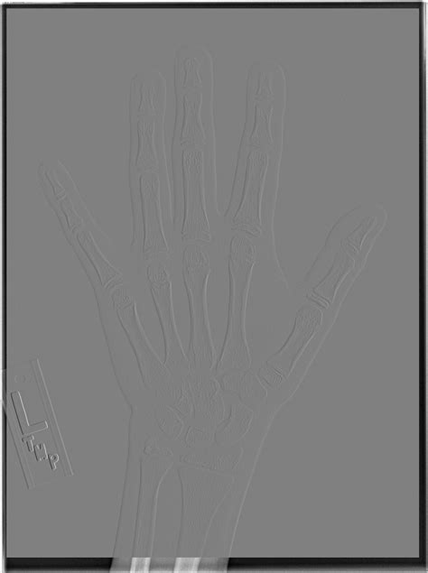 [solved] how to remove white borders around x ray image with opencv