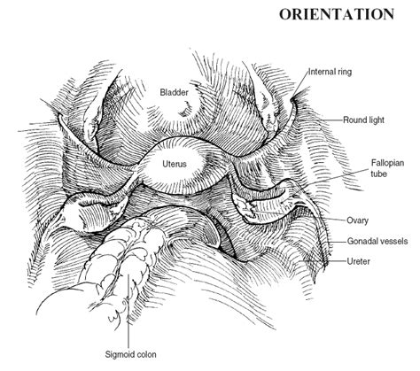 Laparoscopic Surgery Of The Female Pelvis Basicmedical Key
