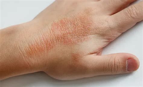 5 Common Eczema Triggers Dermatology And Aesthetics Located In Brooklyn