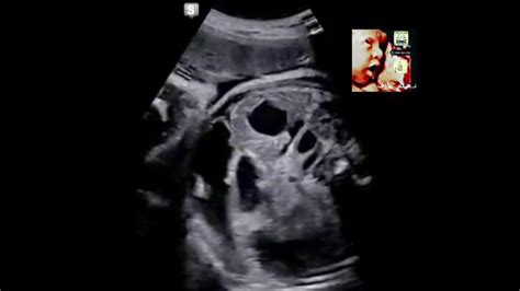 Jejunal Atresia Fetal Ultrasound By Dr Haissam Aref Dms Msc Md