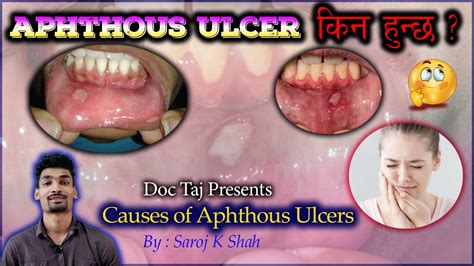 Aphthous Ulcers ओठमा अल्सर किन हुन्छ Canker Sores Causes Dentistry