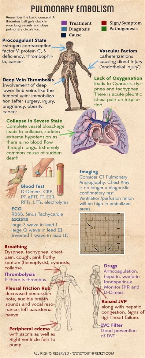 Pulmonary Embolism Symptoms Causes And Treatment Heal
