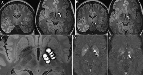 White Matter Connectivity Of Subthalamic Nucleus And Globus Pallidus