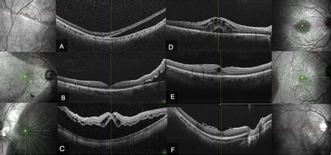 Macula Status Rhegmatogenous Retinal Detachment Rrd Patterns A