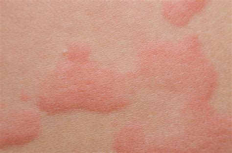 Hives Treatment Nyc Common Causes And Diagnosis Dr Michele Green