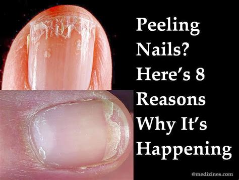 Peeling Nails Heres 8 Reasons Why Its Happening