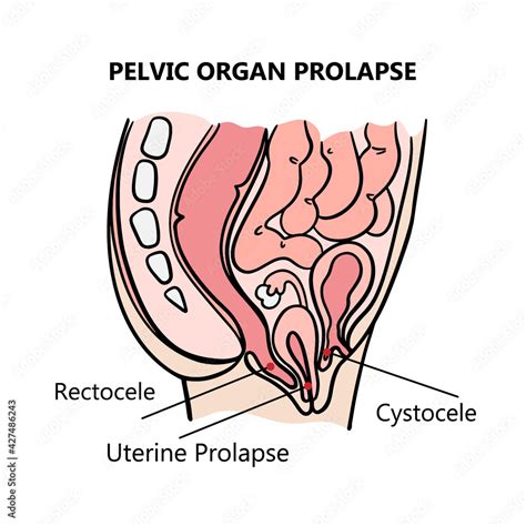 Pelvic Organ Prolapse Of Women General Diagram With Explanatory Text