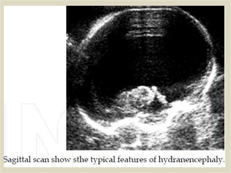 Presentation1 Pptx Ultrasound Examination Of The 2nd And 3rd Trimester…