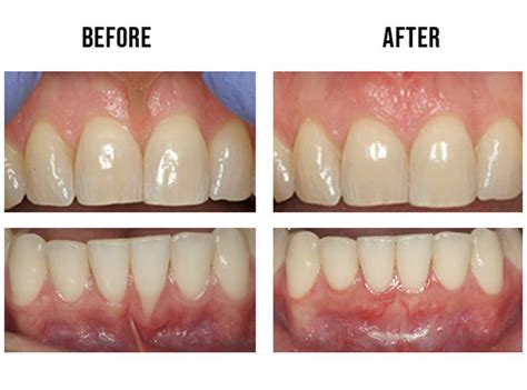 Frenectomía Dr Stella Gonzalez Dental Aesthetics