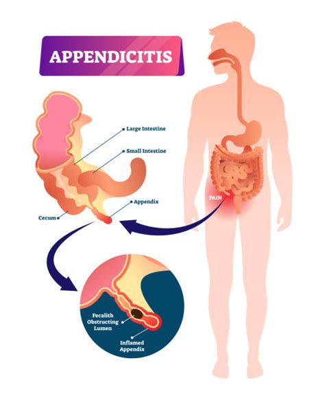 Appendicitis Closeup Appendix Inflammation Vector Illustration
