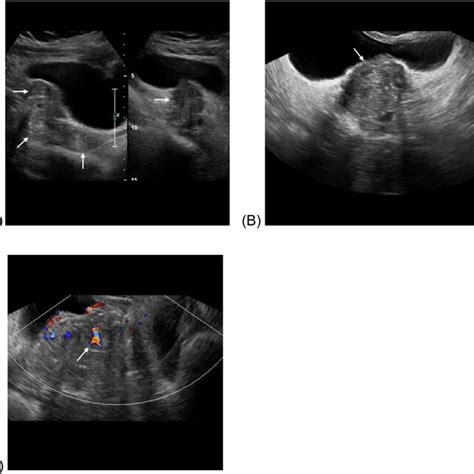 Transabdominal And Transvaginal Pelvic Ultrasound A Transabdominal