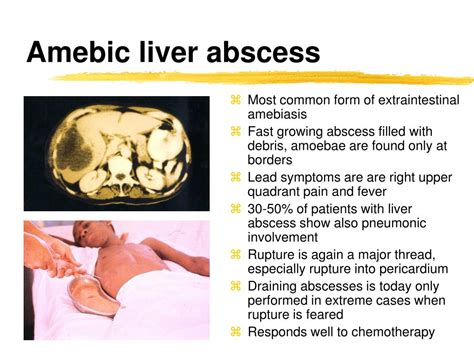 Liver Abscess Amebiasis Due To Entamoeba Histolytica