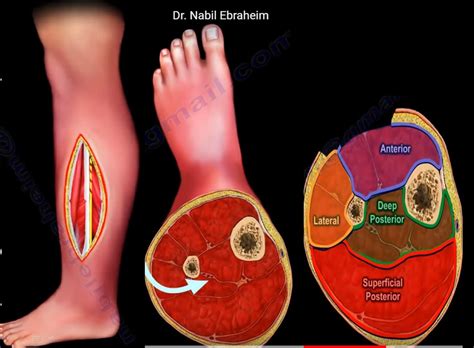What Is Compartment Syndrome Quizlet At Lillie Cowan Blog