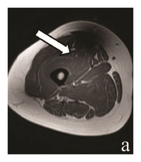 Mr Dr And Histopathology Imaging Of The Right Thigh A Axial