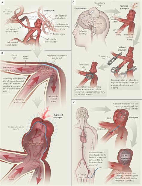 Subarachnoid Hemorrhage Nejm
