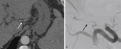 Vascular Anatomy Of The Abdominal Aorta And The Inferior Vena Cava
