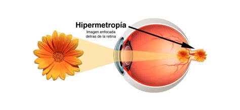 ¿qué Es La Hipermetropía Y Qué Síntomas Tiene