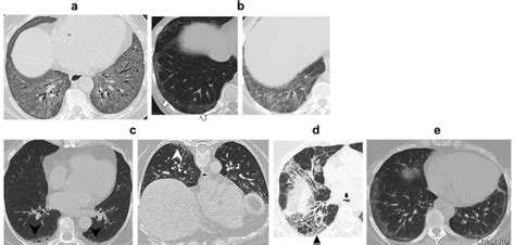 A Chest Ct Scan Of A 52 Year Old Female With Ssc Demonstrating Lower