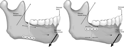 Management Of Fractures Through The Angle Of The Mandible Oral And