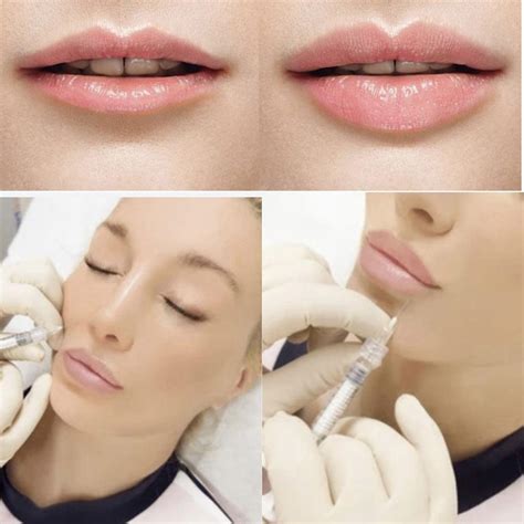 Foundation Dermal Filler Course The Art Of Aesthetics Beauty
