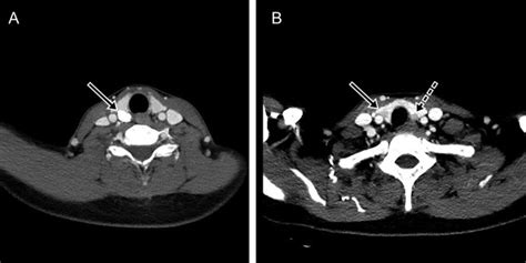 Parathyroid Glands And The Thyroid Nodule On Computed Tomography A A