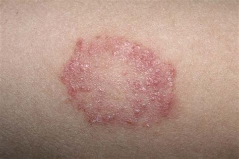Membedakan Gatal Gatal Akibat Kurap Dan Infeksi Jamur Candida