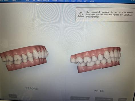Severe Overbite Issue Anyone Having Similar Experience With Invisalign