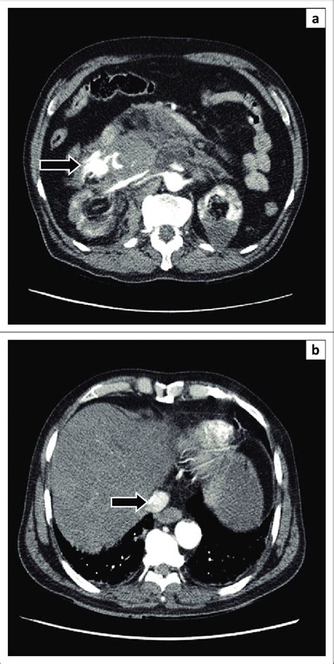 A Axial Contrast Enhanced Computed Tomography Scan Demonstrating