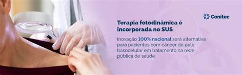 Terapia Fotodinâmica é Incorporada No Sus — Comissão Nacional De