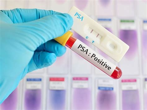 no worries psa bounce with prostate cancer tied to sex