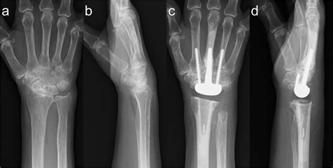 Preoperative A Posteroanterior And B Lateral Radiographs Of The