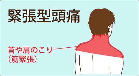 緊張型頭痛や片頭痛に対する鍼灸 東京都練馬区の鍼灸院 成鍼堂